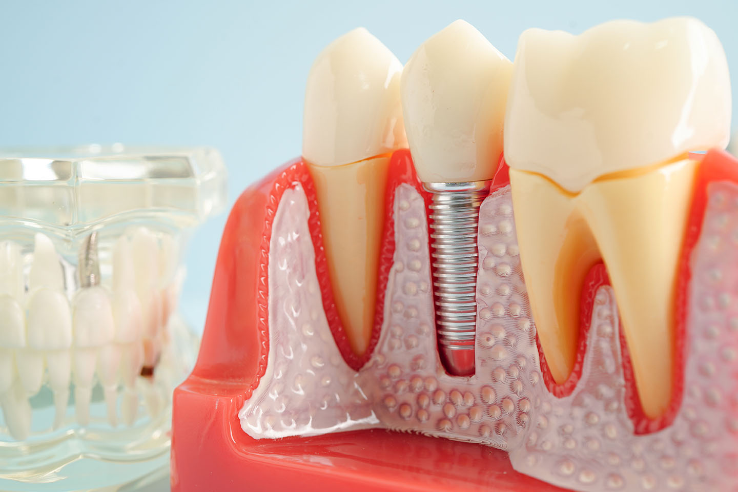 Dental Implant Restoration - DR. FRANKIE NEMAN